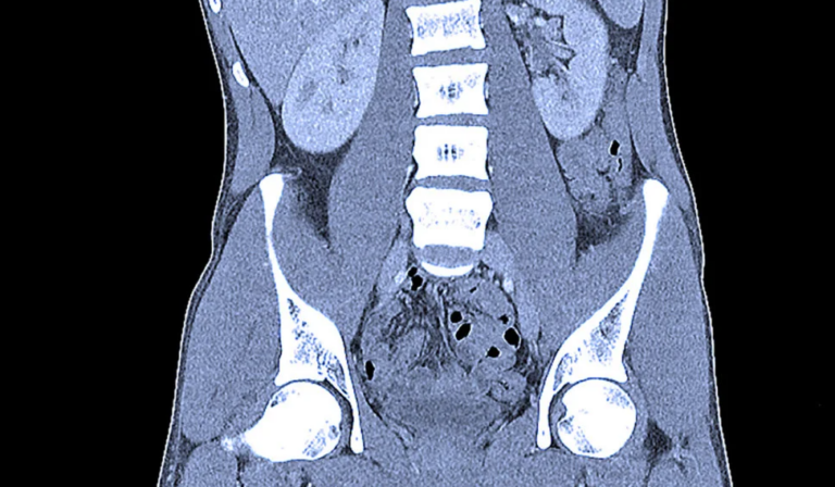 Is CT Scan Contrast Dangerous? Here's What You Need to Know - CT Scan ...